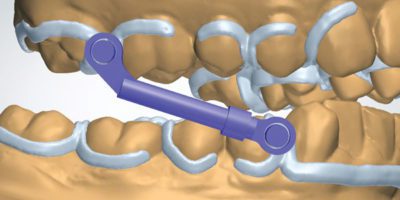 Great Lakes Dental Technologies and new appliance designs