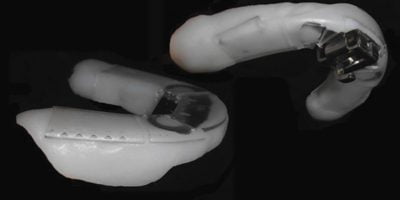 SnoreHook custom oral appliance for snoring