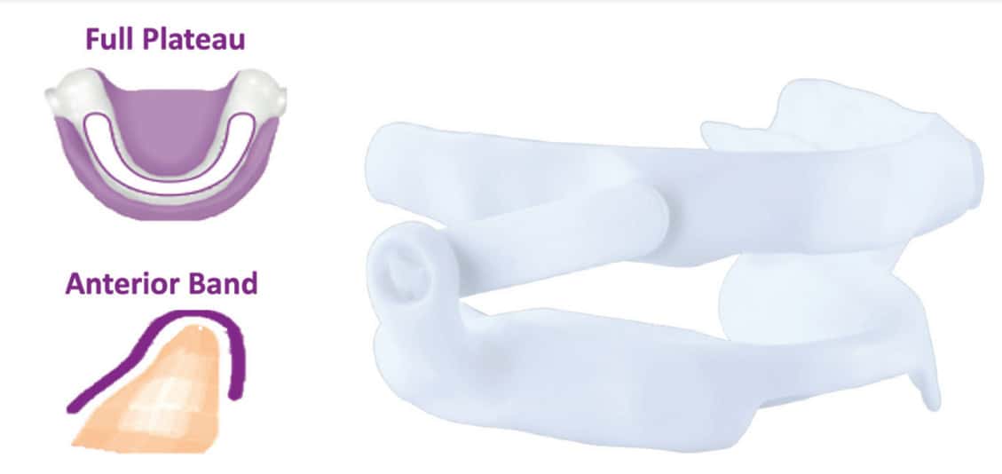 OAT therapy — minimizing tooth movement