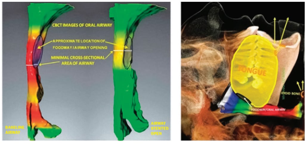 Basic principles for the design of oral appliance therapy