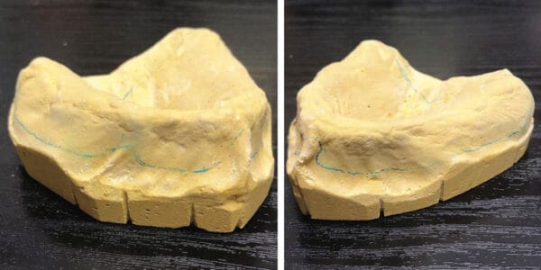 Mandibular Advancement Device — a protocol for complicated patients