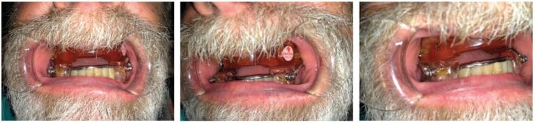 Mandibular Advancement Device — a protocol for complicated patients