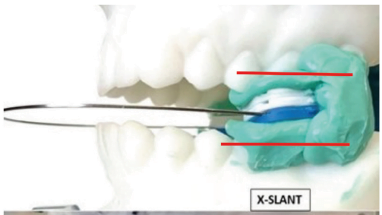 X-Slant molar bite stabilization system — patients can try it before ...