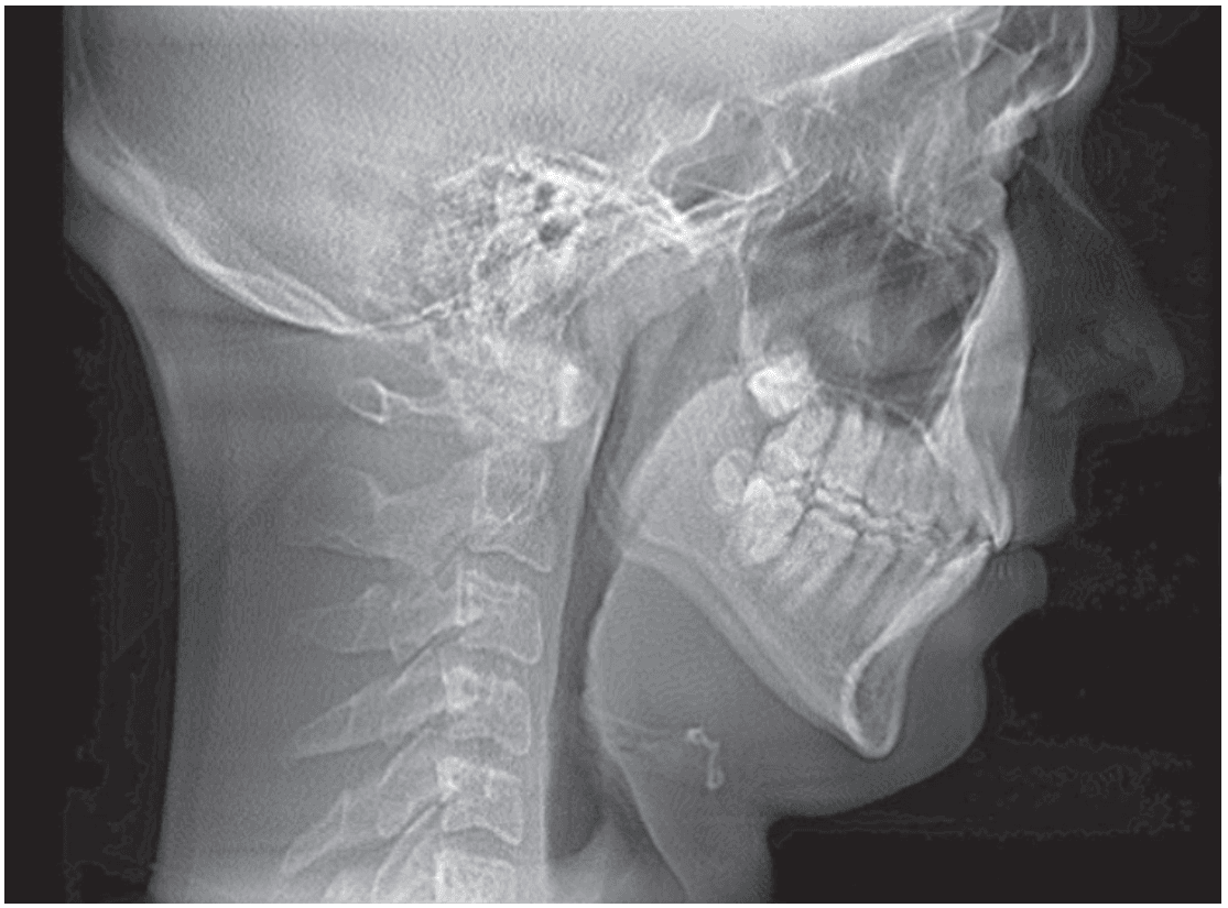 Malocclusion and SRBD — Screening and treatment can change children’s lives